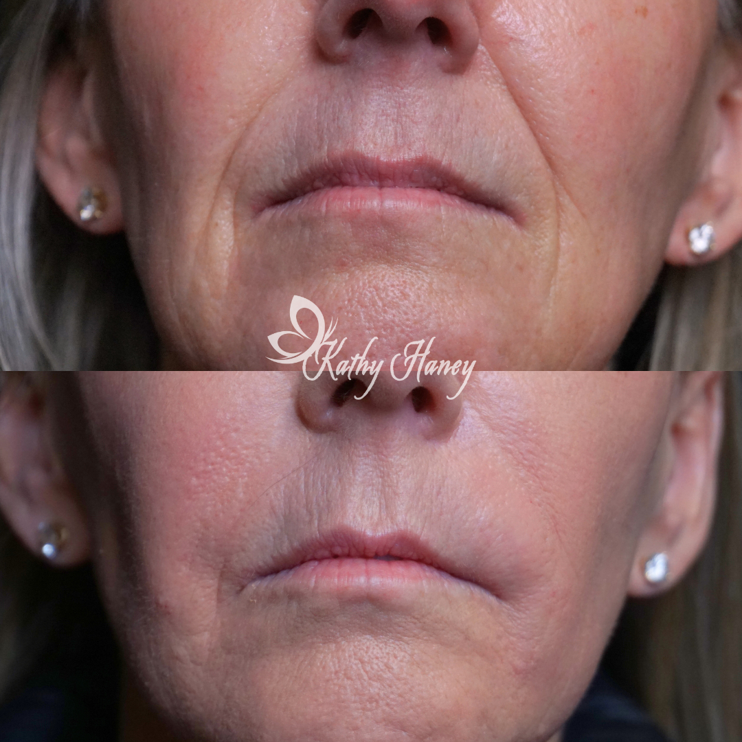 Nasolabial Fold Correction – Transformation MediSpa